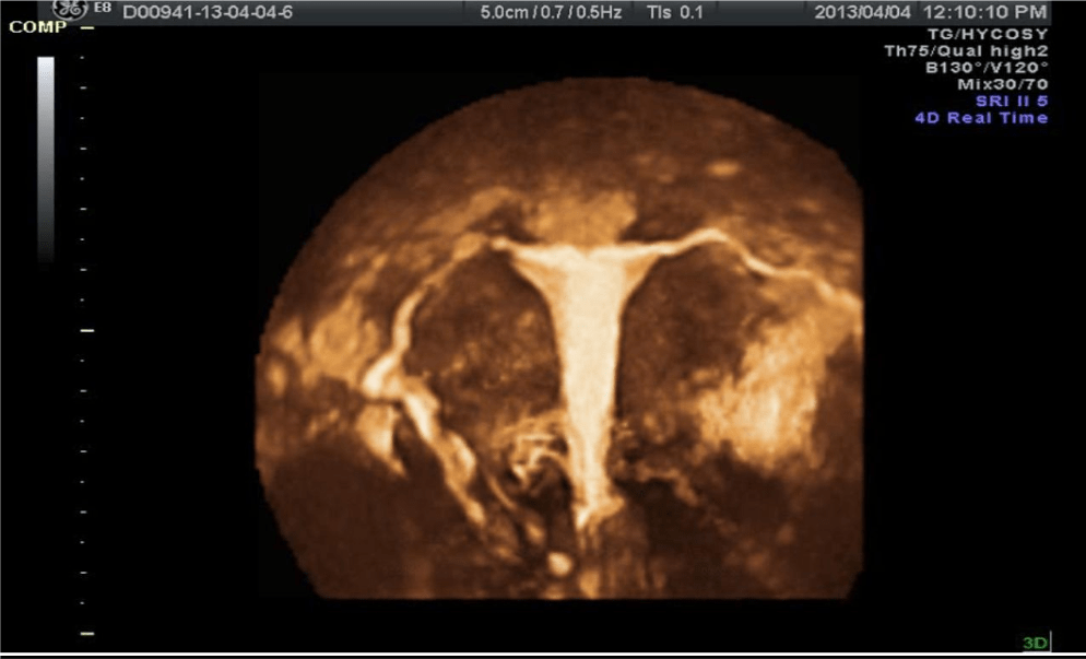 Υπερηχογραφική Σαλπιγγογραφία (HyCoSy) - Δρ. Αναστάσης Αναστασιάδης